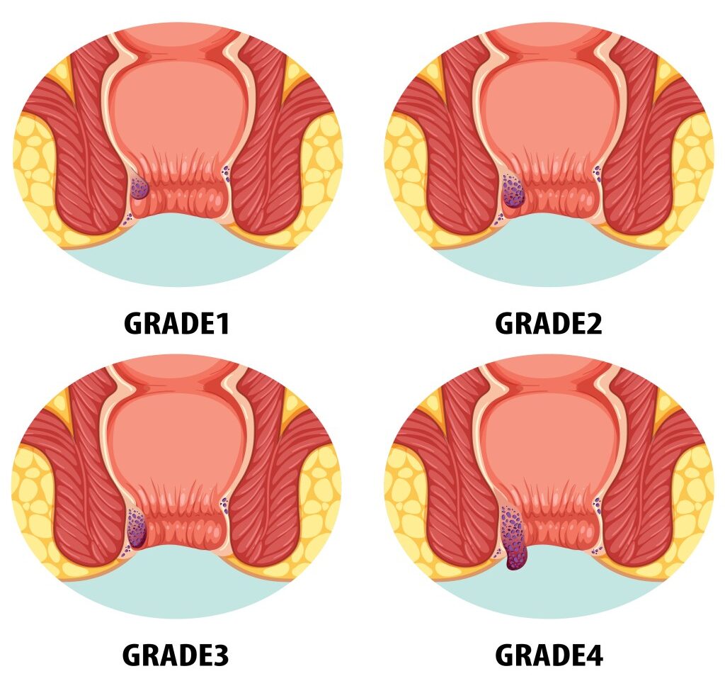Hemorrhoids Venkateswara Ano Rectal Hospital